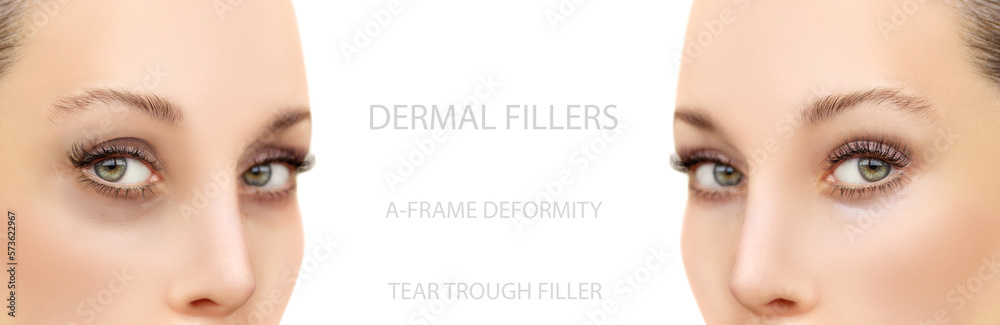 Tear Trough Filler,A-frame deformity. Fat grafting or dermal filler ...