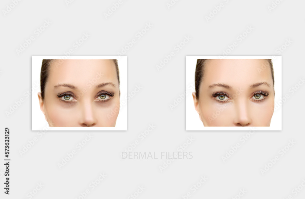 Tear Trough Filler,A-frame deformity. Fat grafting or dermal filler ...