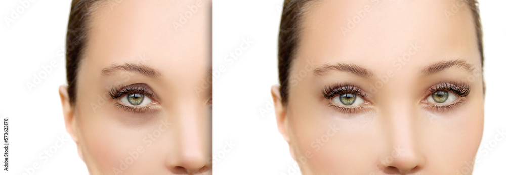 Tear Trough Filler,A-frame deformity. Fat grafting or dermal filler ...