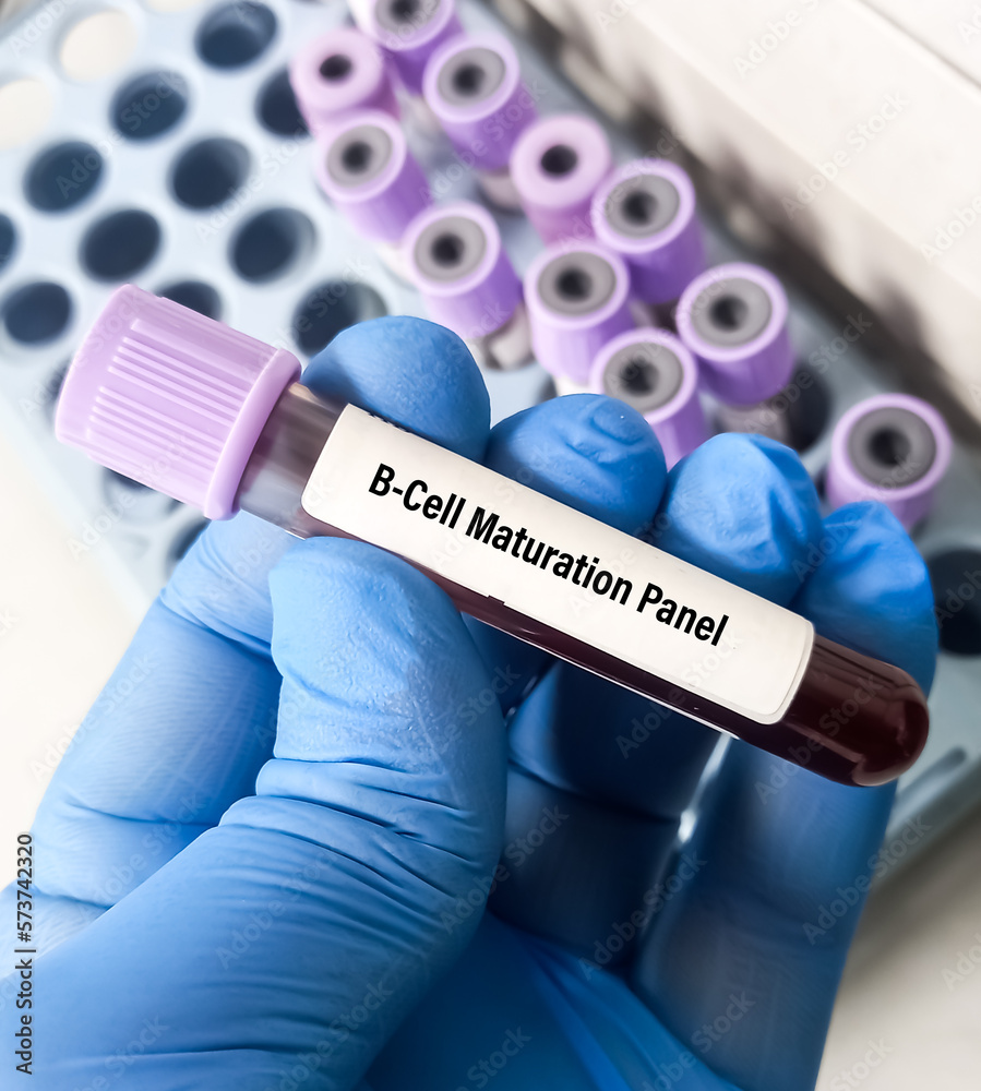 B Cell Maturation Panel test. B-cell leukemia or lymphoma panel test ...