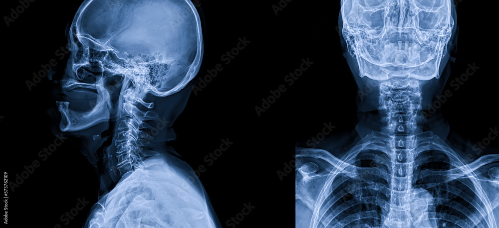 Blue tone radiograph on dark background in hospital.Doctor used xray ...