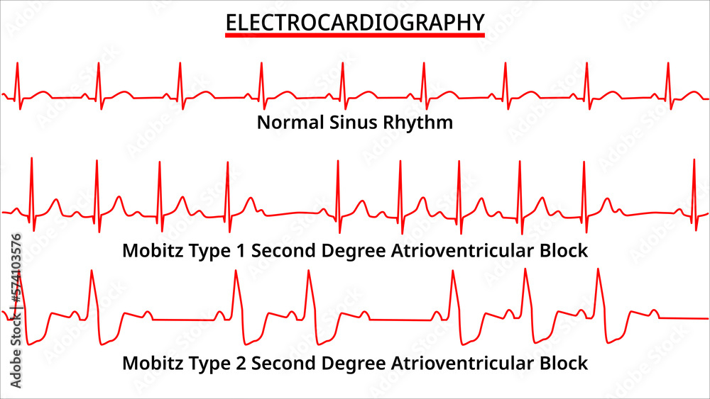 Set of ECG Common Abnormalities - Normal Sinus Rhythm - Mobitz Type 1 ... Set of ECG Common Abnormalities - Normal Sinus Rhythm - Mobitz Type 1 ...