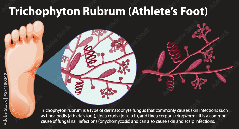 Trichophyton Rubrum fungal infection Stock Vector | Adobe Stock