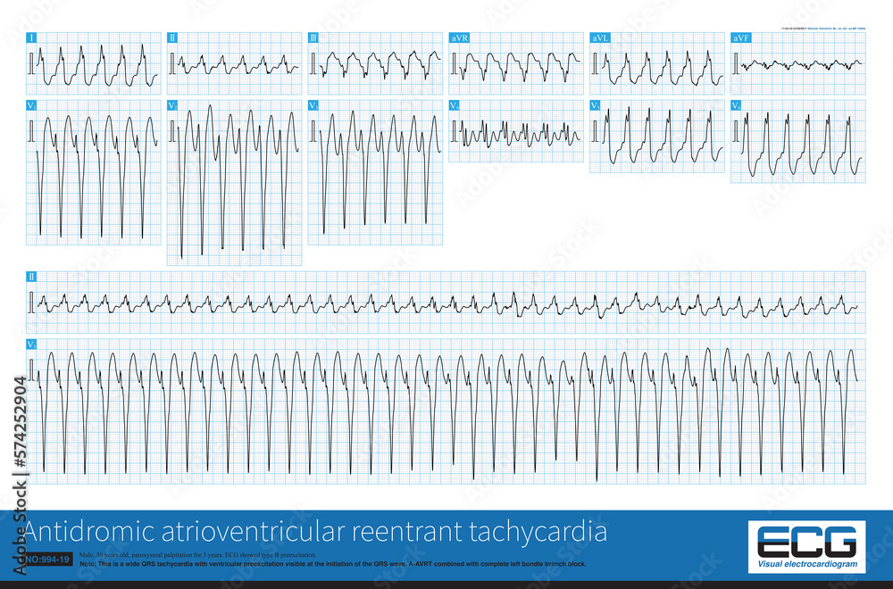Atrioventricular accessory pathway is a cause of wide QRS tachycardia ...
