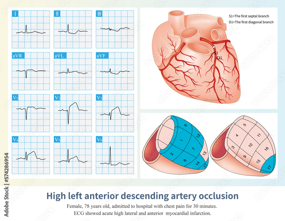 When the occlusion of the LAD is located in the common trunk above the ...