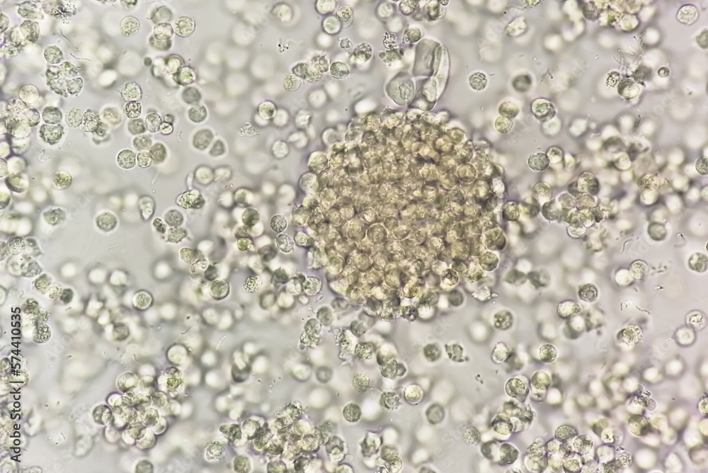 Pyuria or leukocyturia is the condition of urine containing white blood ...