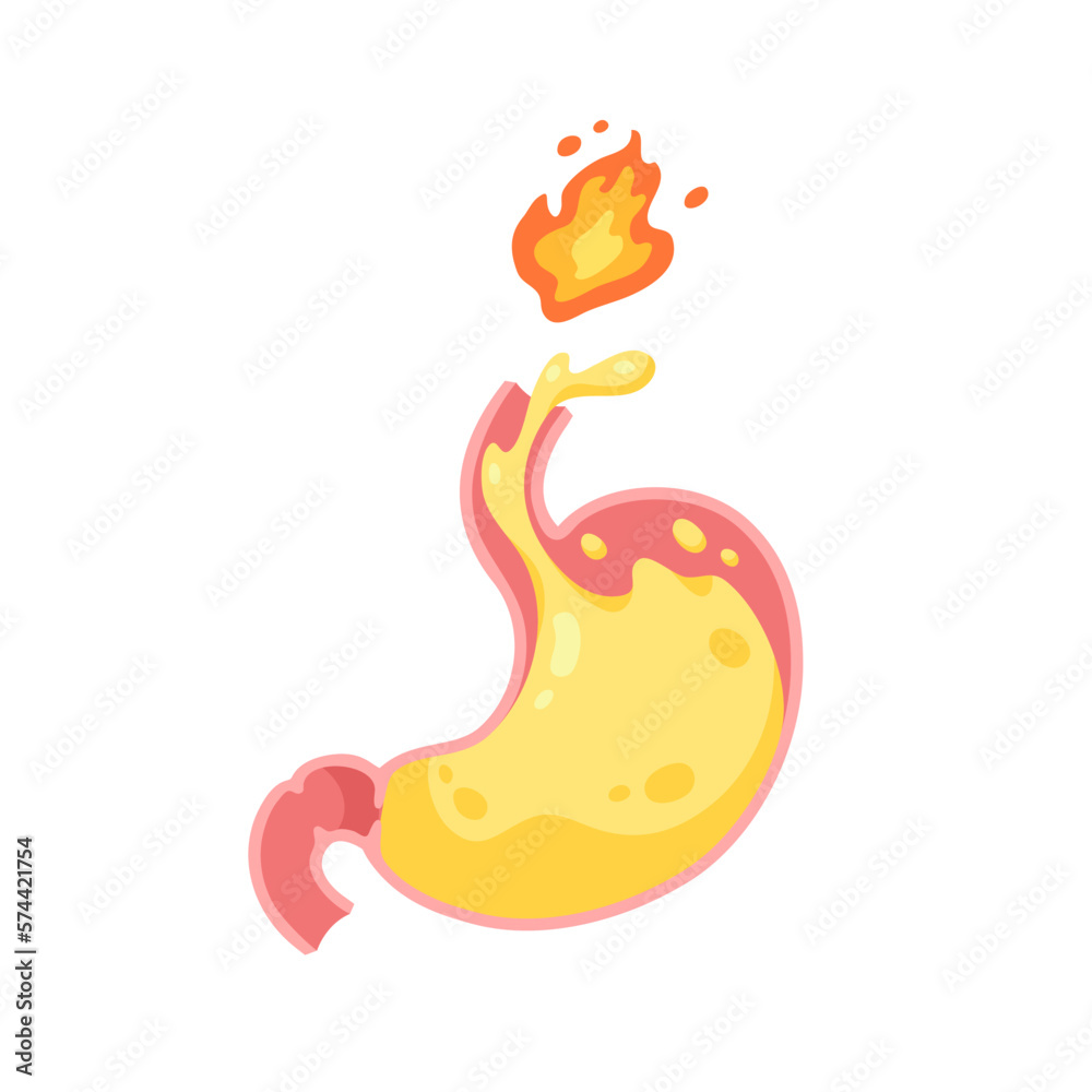 Vecteur Stock Gastroesophageal reflux disease. Sphincter open allowing acid reflux to esophagus ...