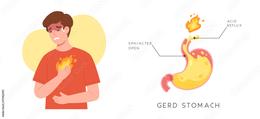 Man suffering from GERD symptom with acid reflux because of sphincter ...