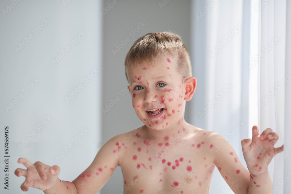 Foto de Portrait of a grimacing boy with a rash on his face from ...