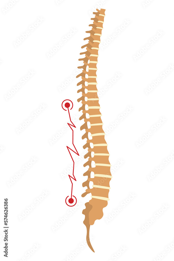 Spinal deformity. Symbol of spine curvatures or unhealthy backbones ...