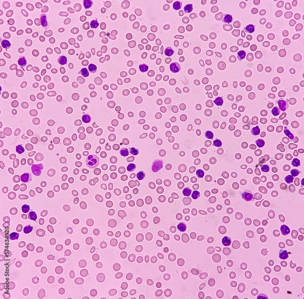 Lymphocytosis with Thrombocytopenia. Smear show white blood cells, red ...