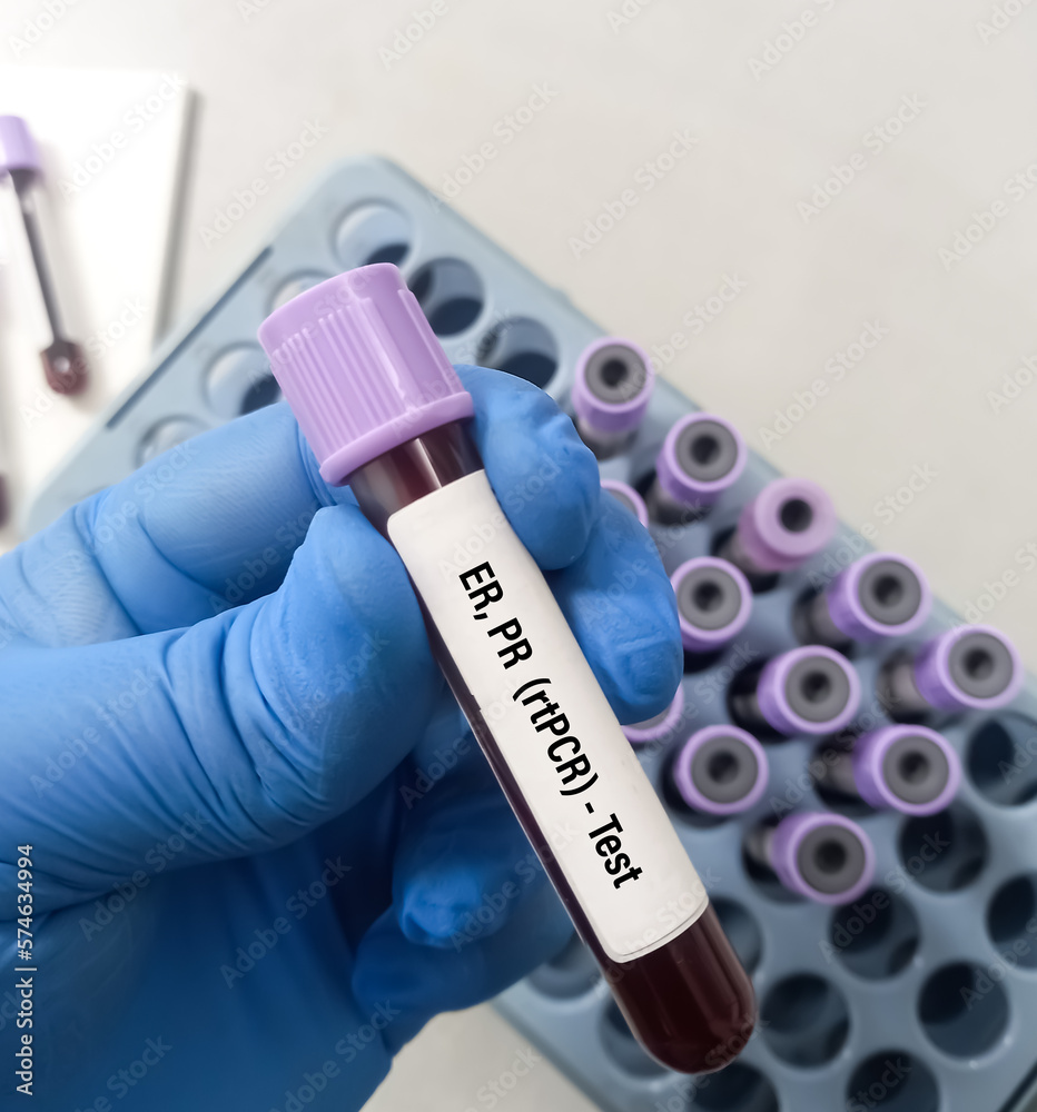 Blood sample for ER and PR PCR testing for breast cancer diagnosis ...