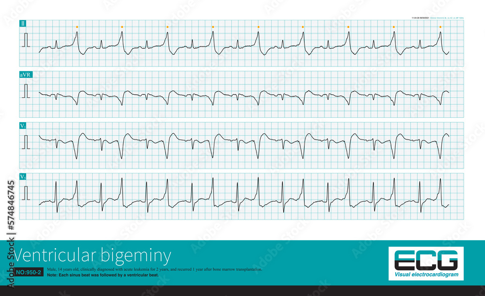 A 14-year-old leukemic child had a sudden wide QRS tachycardia with a ...