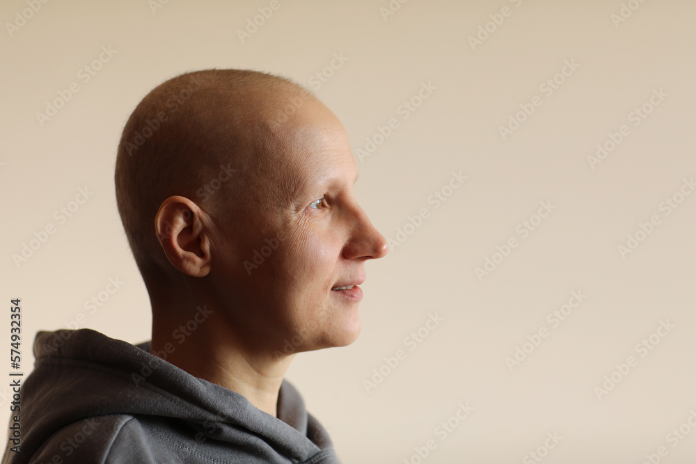 Effects of chemotherapy. Portrait of funny face millennial hairless ...