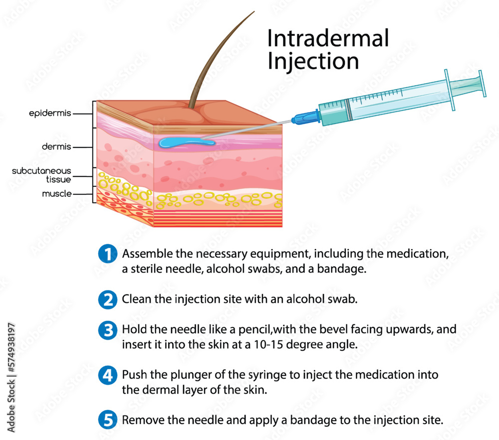 Intradermal And Subcutaneous Injection Stock Vector