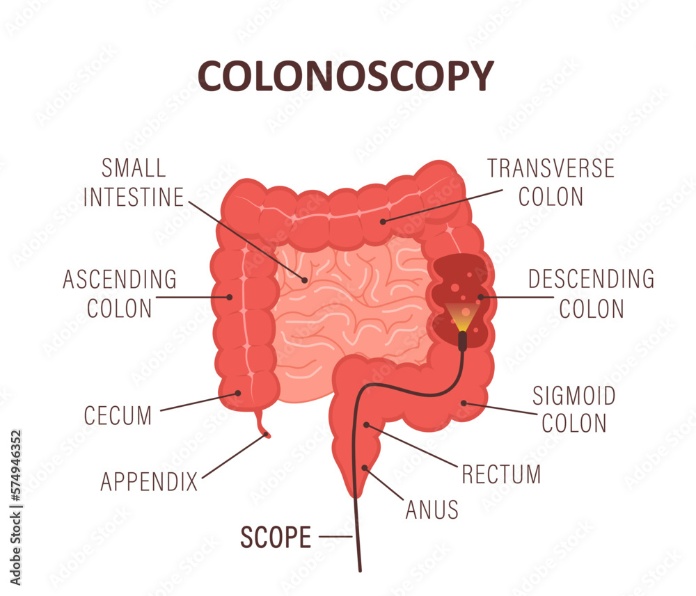 Colonoscopy concept. Intestine exam and treatment. Bowel polypectomy ...