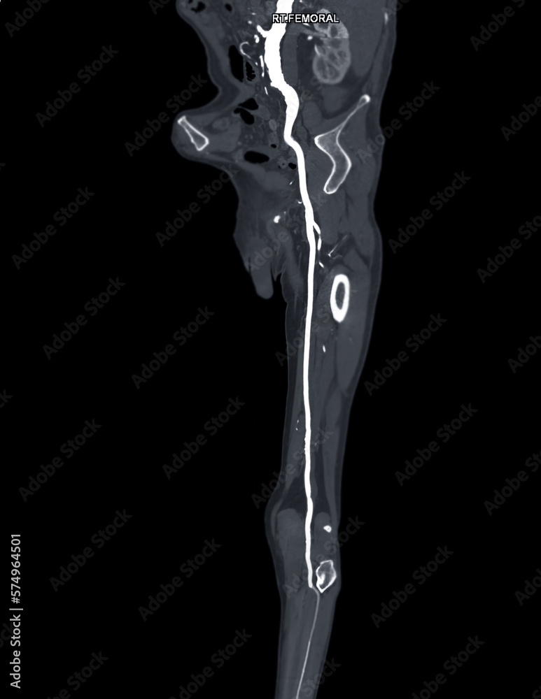 CTA femoral artery run off MPR curve showing Left femoral artery for ...