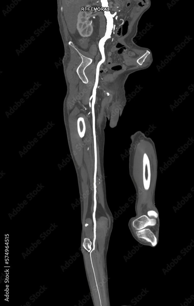 CTA femoral artery run off MPR curve showing Right femoral artery for ...