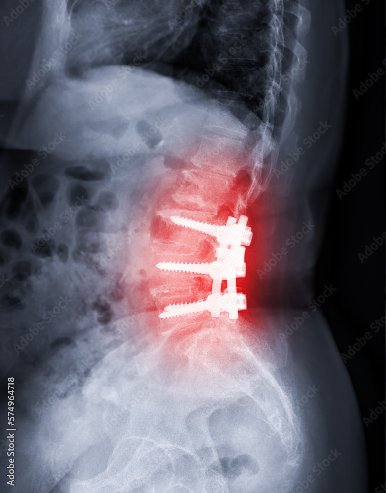 X-ray image of Lumbar spine showing pedicle screw fixation and ...