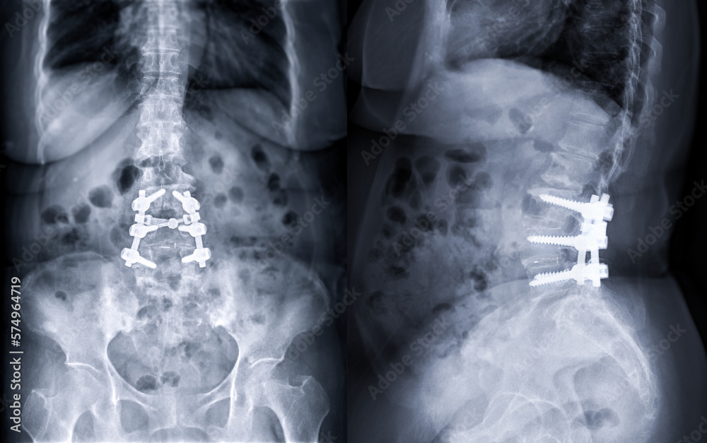 X-ray image of Lumbar spine showing pedicle screw fixation and ...