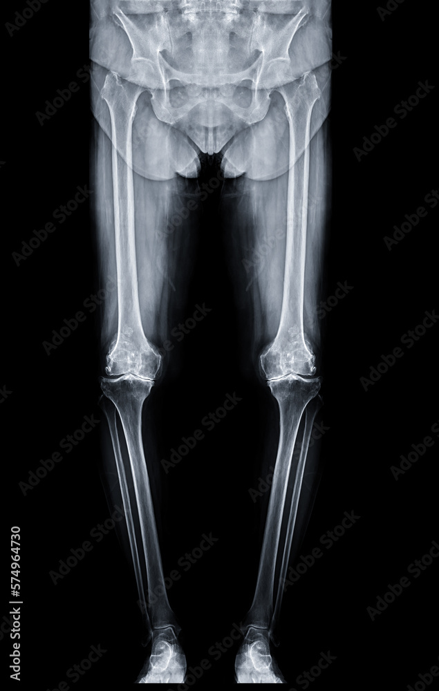Poster Scanogram is a Full-length standing AP radiograph of both lower ...