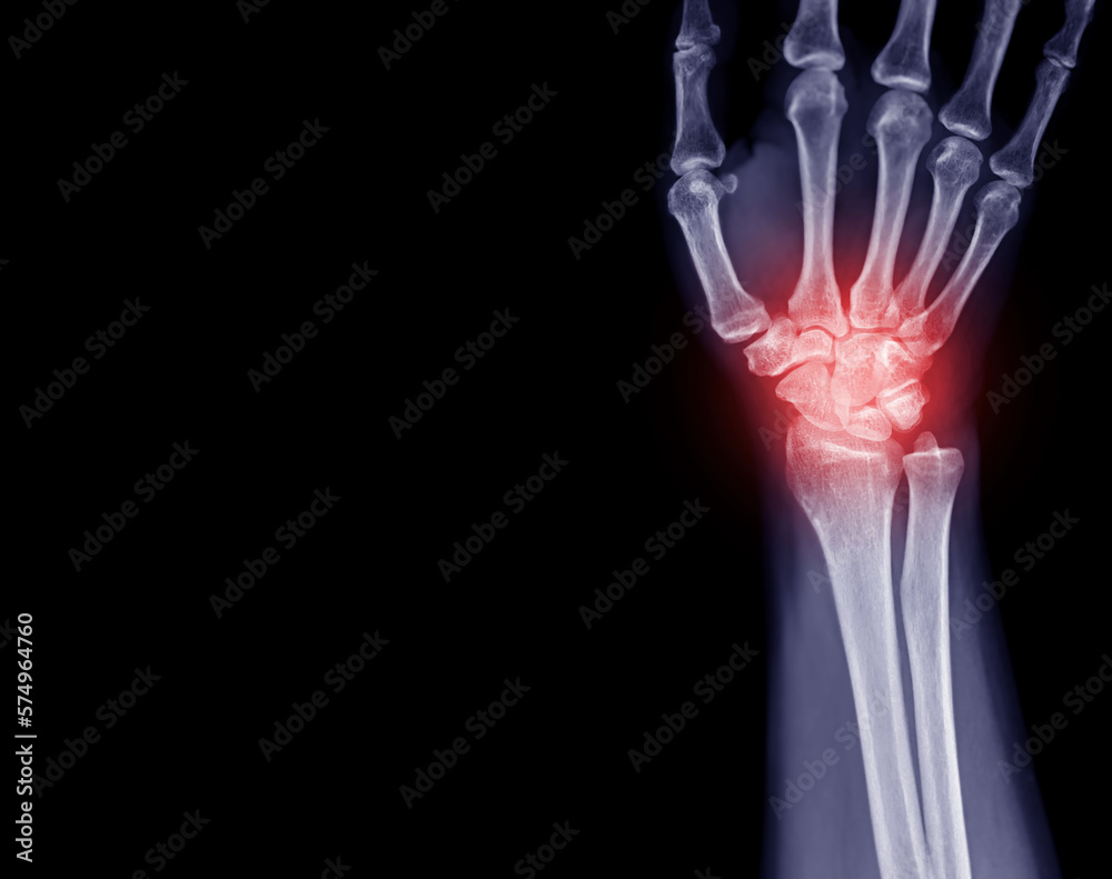 X-ray image of wrist joint front view of normal wrist joint. Stock ...