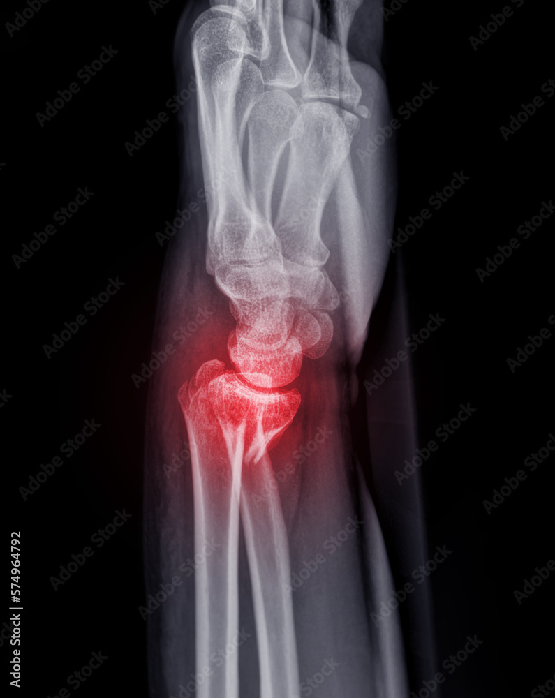 X-ray image of Left wrist joint AP and Lateral view for showing ...