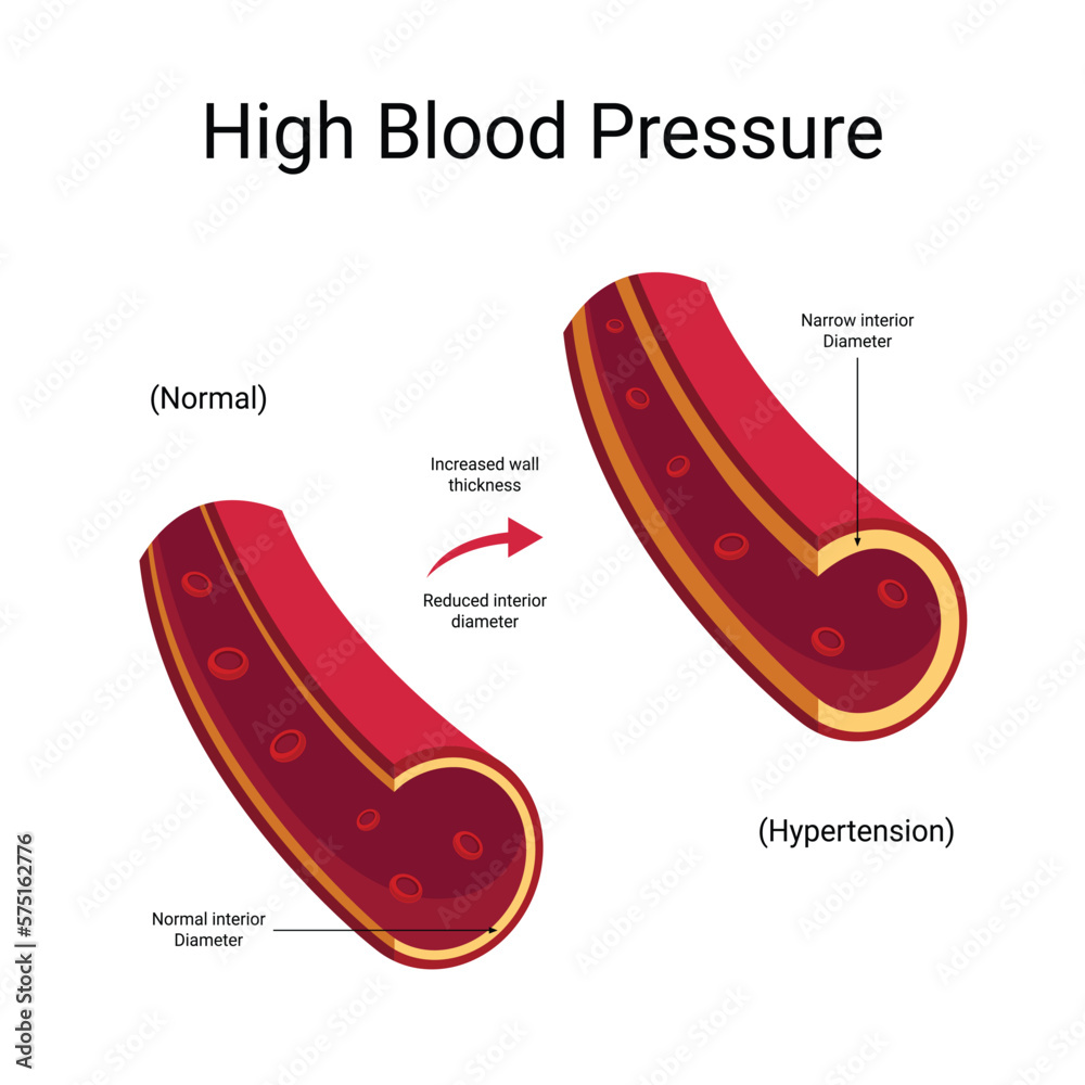 High blood pressure vector illustration, hypertension infographic Stock ...