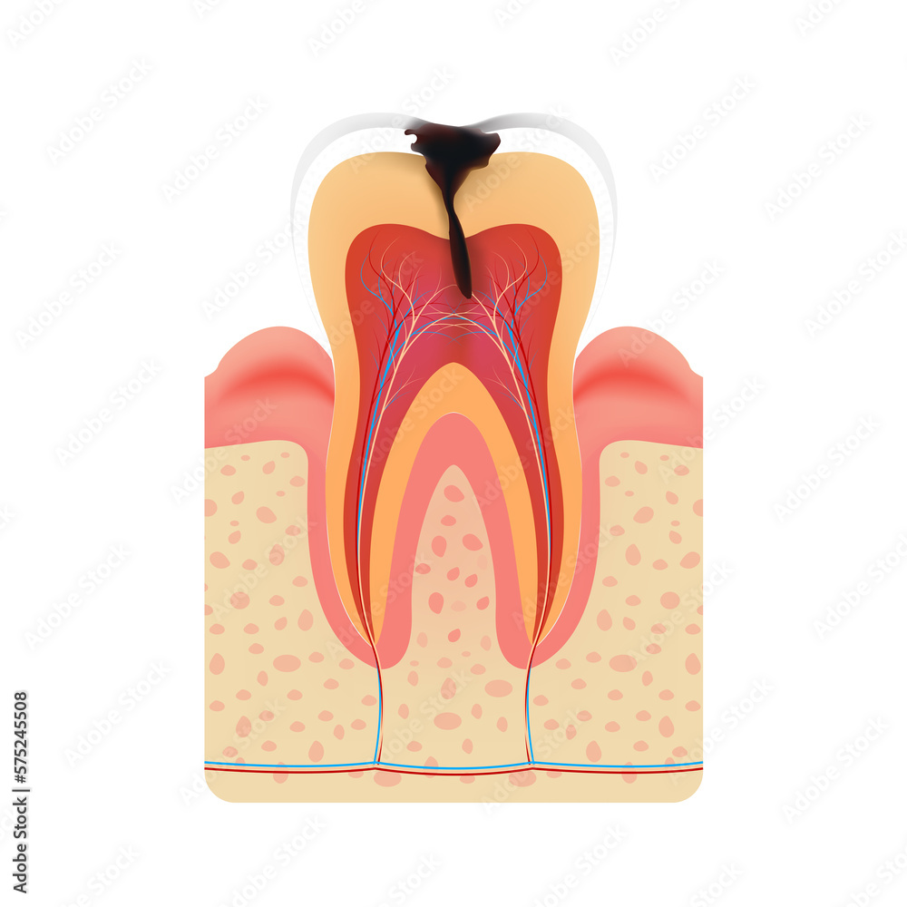 Tooth caries stages, development of teeth decay with enamel and dentin ...