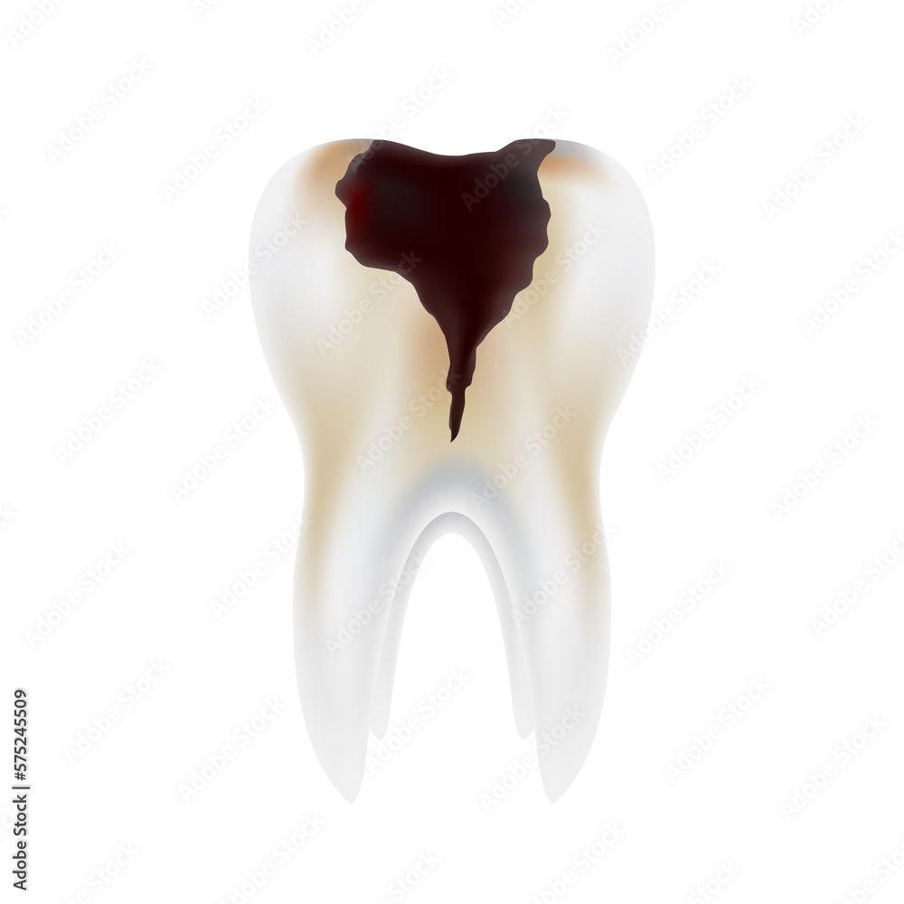Tooth caries stages, development of teeth decay with enamel and dentin ...