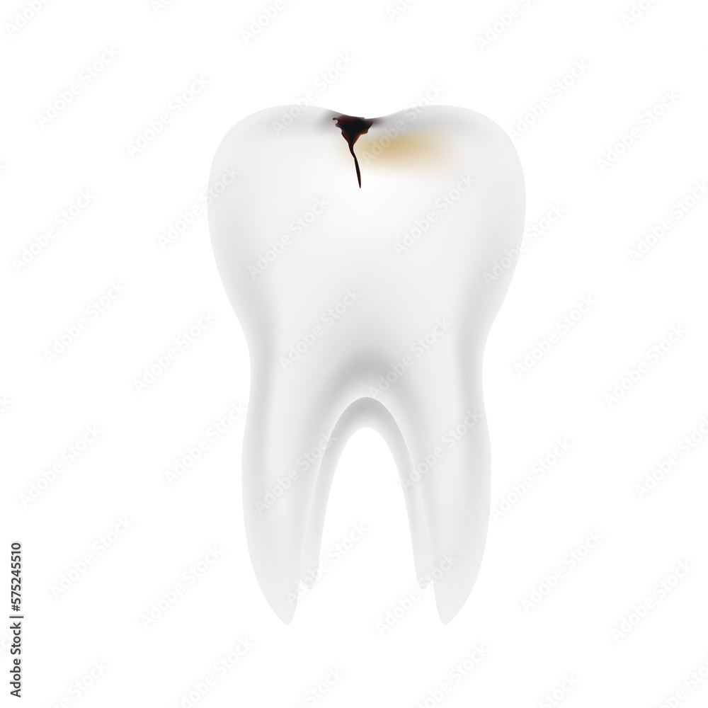 Tooth caries stages, development of teeth decay with enamel and dentin ...