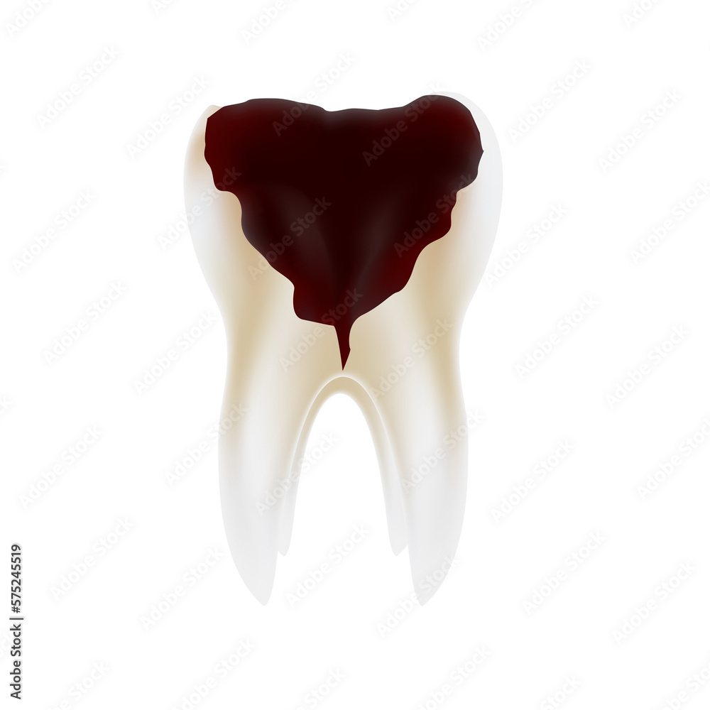 Tooth caries stages, development of teeth decay with enamel and dentin ...