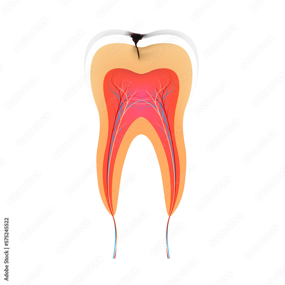 Tooth caries stages, development of teeth decay with enamel and dentin ...