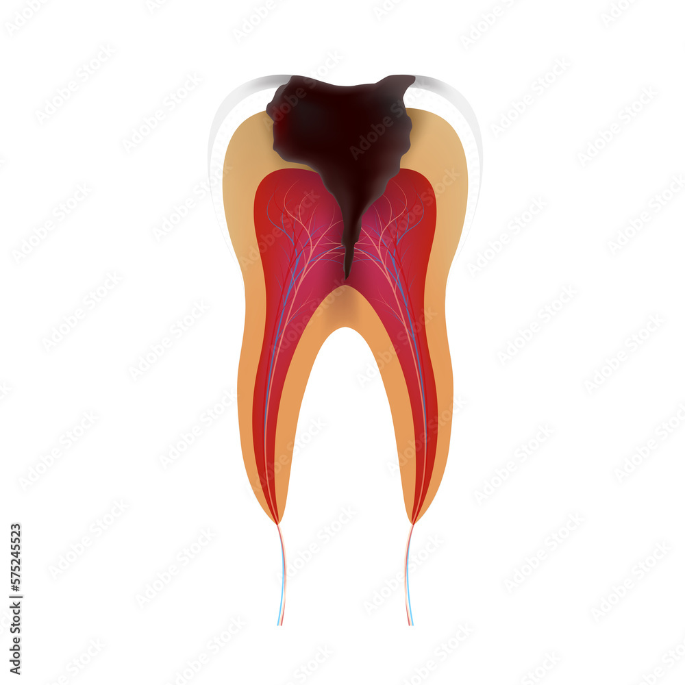 Tooth caries stages, development of teeth decay with enamel and dentin ...