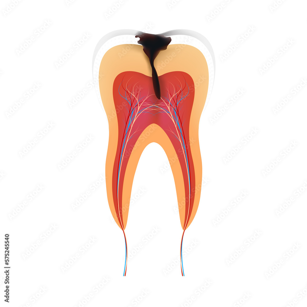 Tooth caries stages, development of teeth decay with enamel and dentin ...