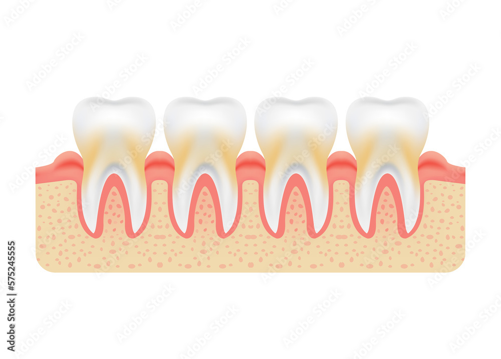 Tooth caries stages, development of teeth decay with enamel and dentin ...