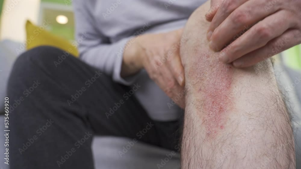 The man is scratching a red rash on the skin of his leg. Man with ...