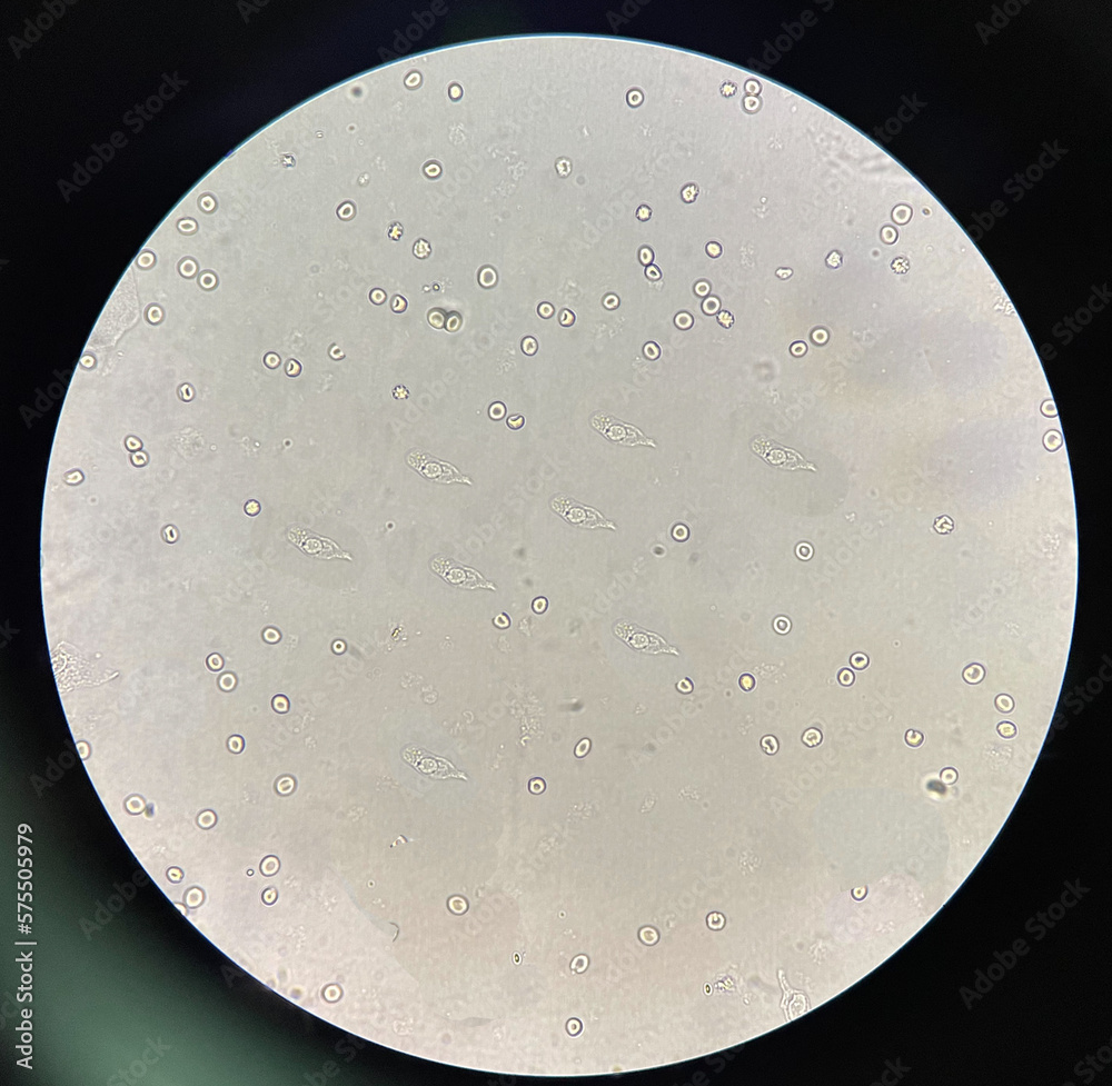 renal epithelial cell with rbc in Urine Stock Photo | Adobe Stock