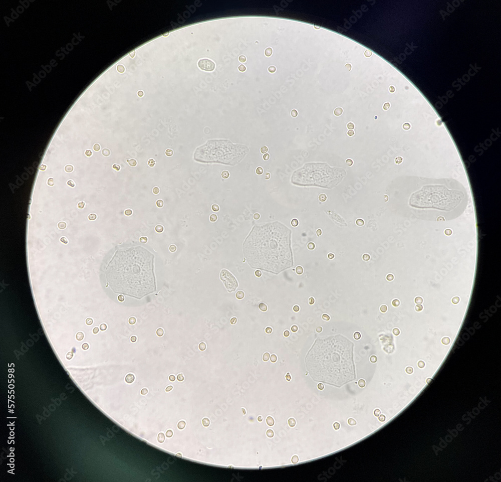 Squamous epithelial cell with rbc in Urine. Stock Photo | Adobe Stock