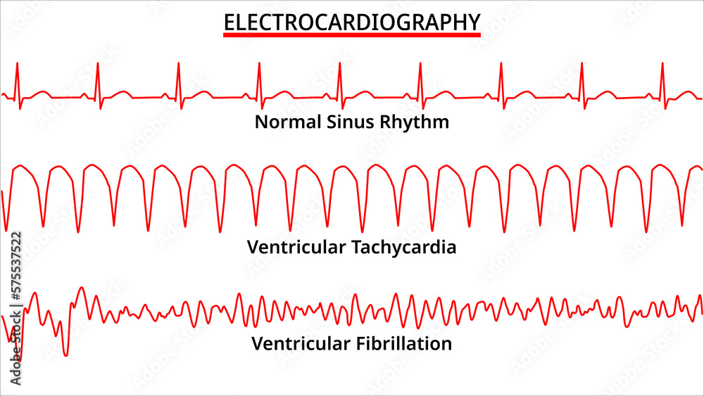 Set Of ECG Common Abnormalities Ventricular Tachycardia Vs