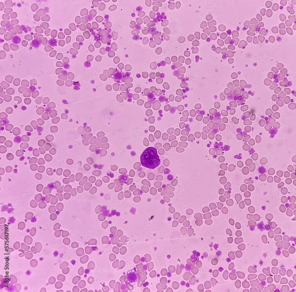 Chronic myeloid leukemia (CML) in accelerated phase also known as ...