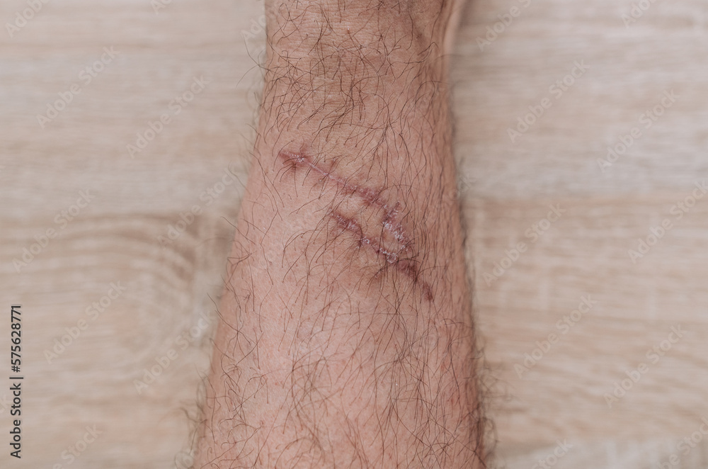A wound on the human body, suture old, deep cut, scar close-up ...