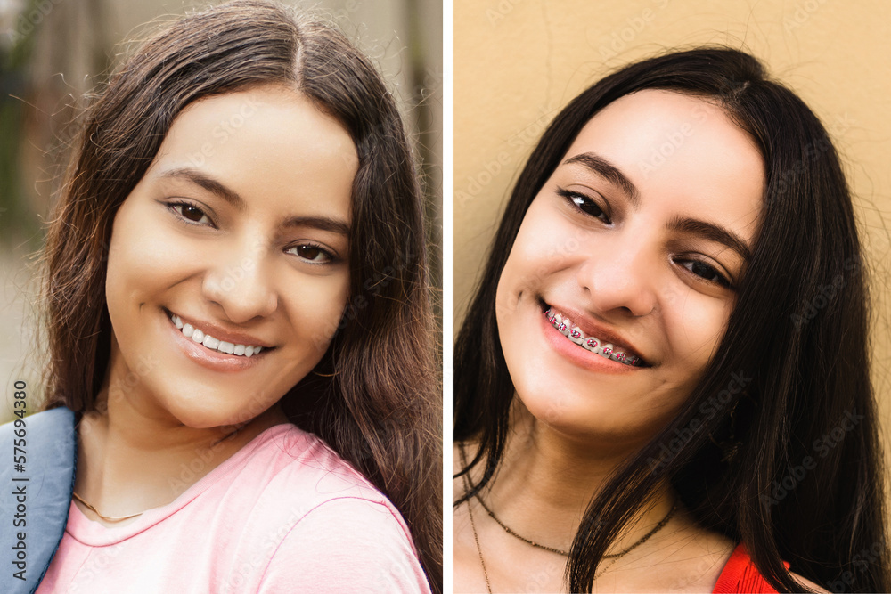 Collage of a before and after of a woman with braces and without braces ...