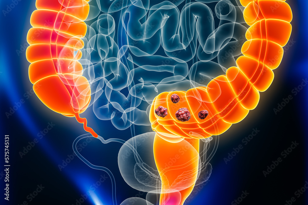 Colon or large intestine cancer with organs and tumors or cancerous ...
