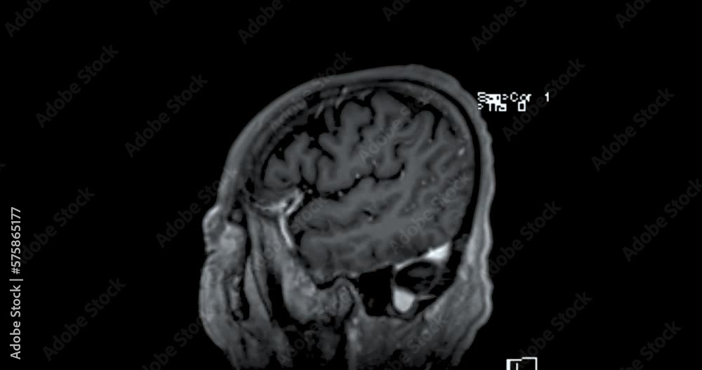 MRI Brain can help doctors look for conditions such as bleeding ...