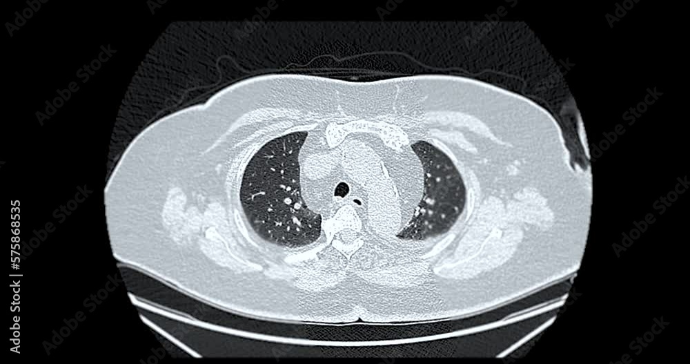 CT Chest or CT Scan of Lung axial View for diagnosis TB,tuberculosis and coronavirus or covid-19 ...