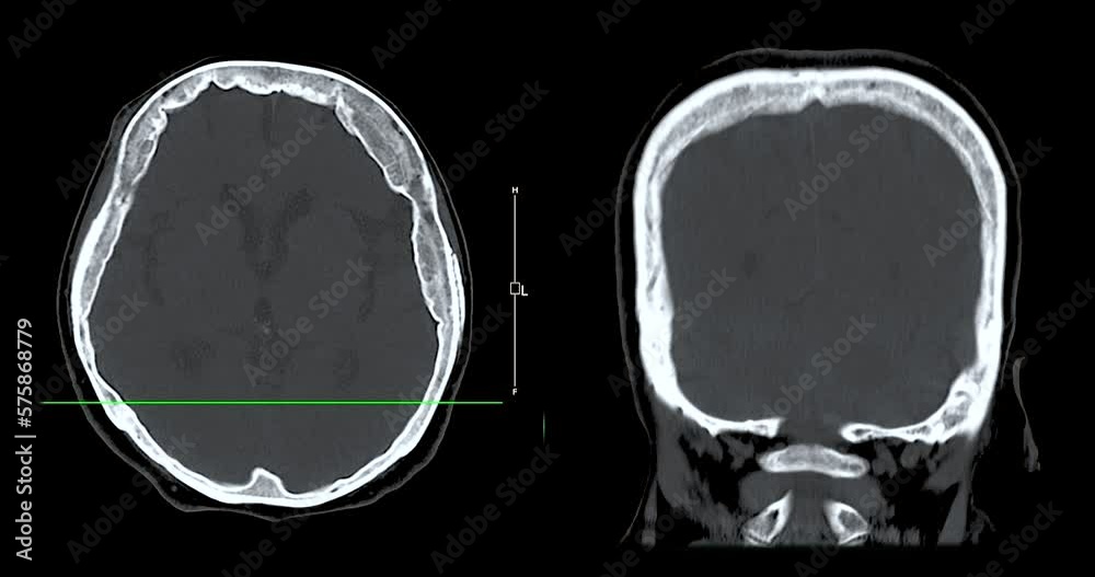 CT scan of the brain for diagnosis brain tumor,stroke diseases and vascular diseases. Stock 비디오 ...