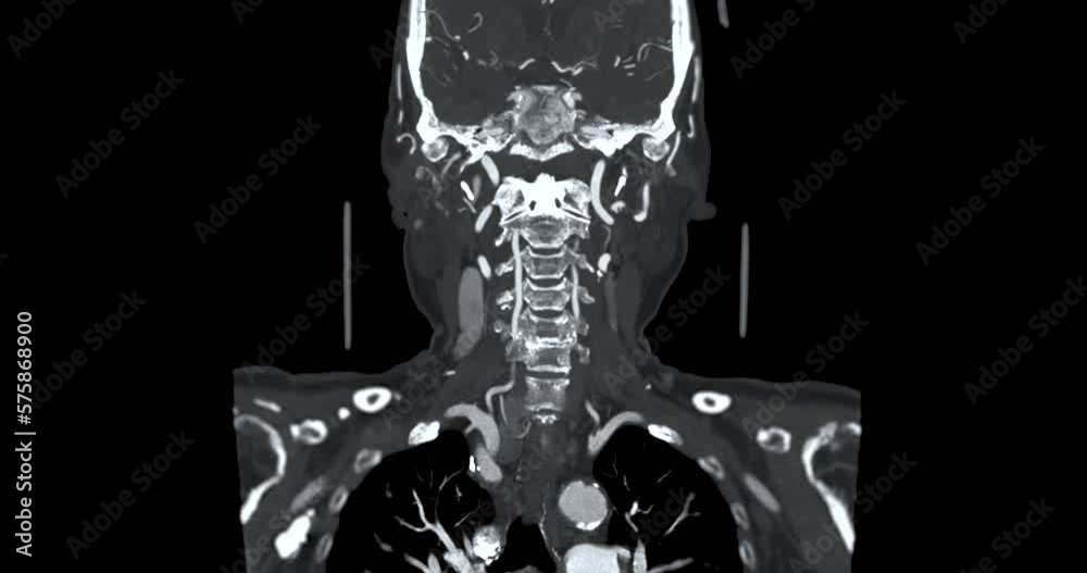 CTA Neck or Carotid artery Coronal view Stock-video | Adobe Stock