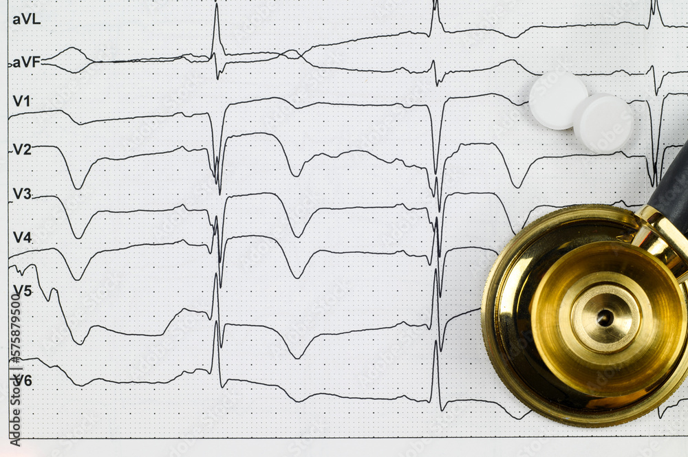 ECG. Myocardial infarction on ECG in chest leads V1-V6, stethoscope and ...