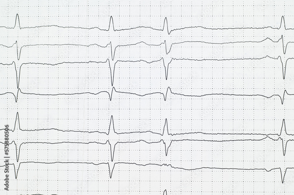 Electrocardiogram with supraventricular extrasystoles lie on the table ...